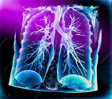 Healthy Lungs Ct Scan Stock Image C0573594 Science Photo Library
