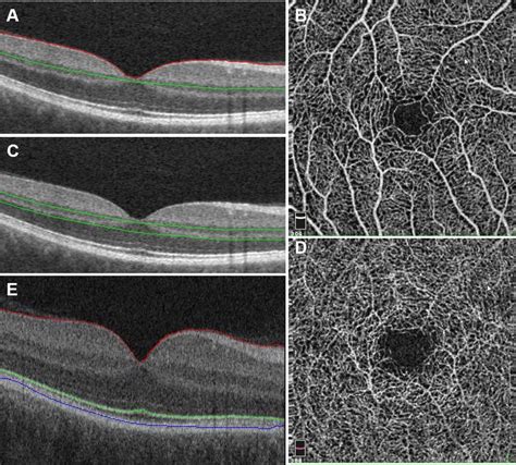Normal Scan And Segmentation Example A Central Foveal B Scan Of A