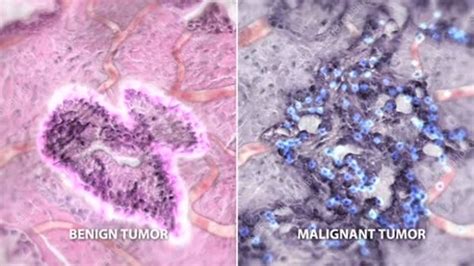 Benign Vs Malignant Tumor Stock Video Clip K0074572 Science Photo Library