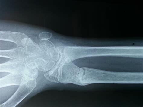 Complications Following Distal Radius Fractures Omqwx