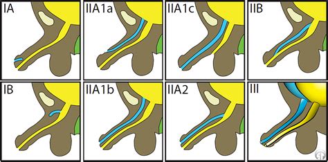 Case Of Urethral Duplication Seen By Voiding Urosonography Clinical