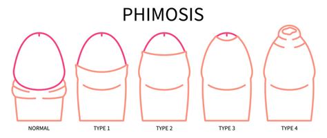 Laser Circumcision For Phimosis