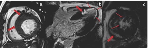 Hypertrophic Cardiomyopathy With Obstructive Coronary Artery Disease