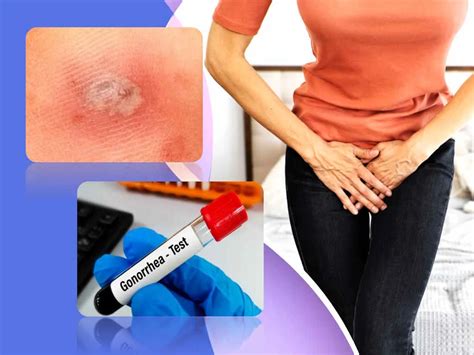 Gonorrhea Symptoms Treatment And Prevention Doctor Zara