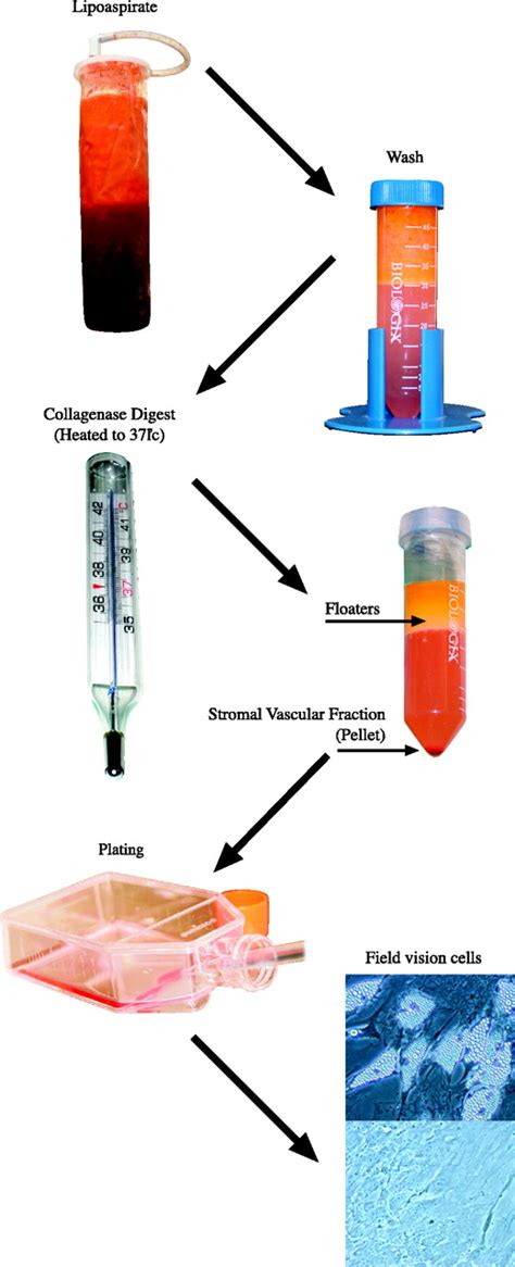 Ray Elbe Penile Fracture
