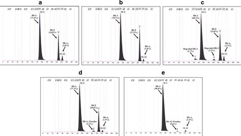 Hb Analysis Using Capillary Electrophoresis Of Subjects With