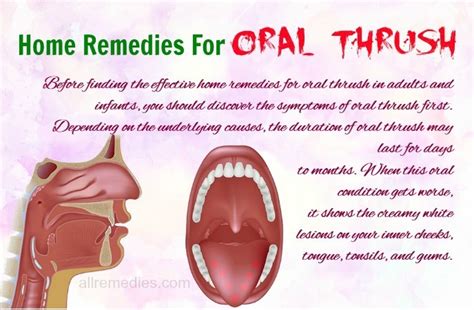 Top 41 Home Remedies For Oral Thrush Causes Symptoms Prevention
