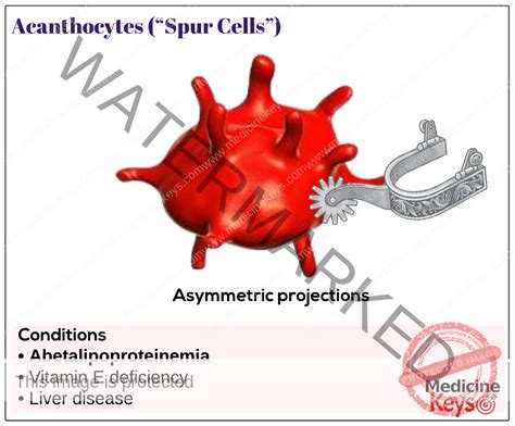 Acanthocytes “spur Cells” Medicine Keys For Mrcps