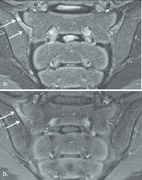 Active Sacroiliitis With Synovitisretroarticular Enthesitis In A