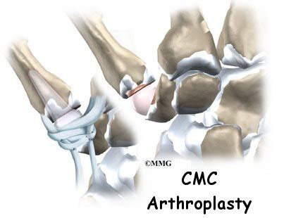 Thumb Joint Operations