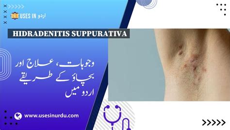 Hidradenitis Suppurativa Uses In Urdu