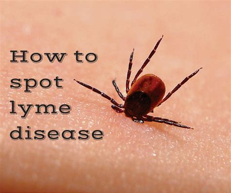 Activmed Clinical Trials Ma Nh Beware The Tick Bite Prevention And