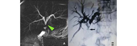 3d Mrcp A Post Cholecystectomy Showing Abrupt Arrest Of The Chd About Download Scientific