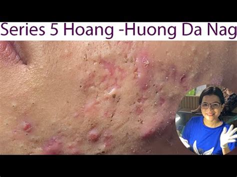 Acne Treatment Huong Da Nang 023 Series 5 Hoang Youtube
