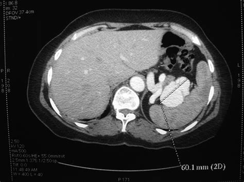 Splenic Artery Aneurysm Ultrasound