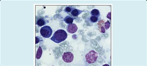 Bone Marrow Myelogram Revealing Severe Hypoplasia Of The Granoblastic
