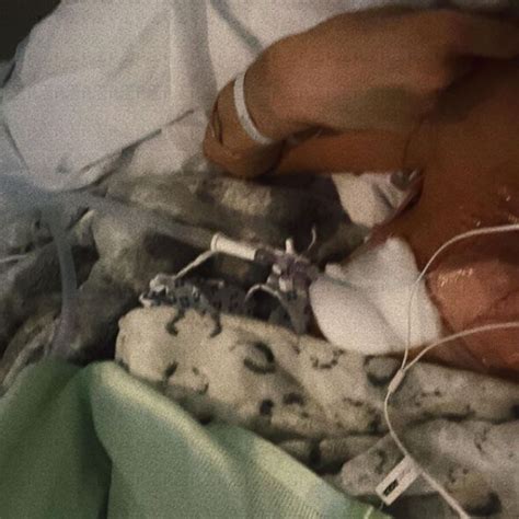 Young Woman Claims Vaping Caused Her Lung To Collapse As She Is