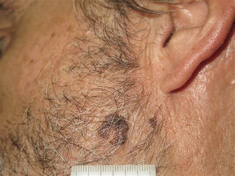Update Of Pathophysiology And Treatment Options Of Seborrheic Keratosis