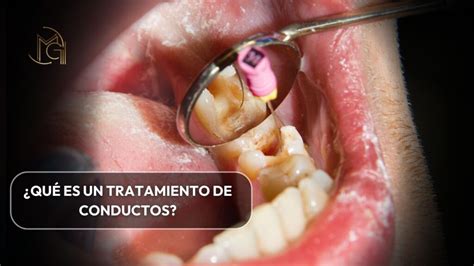 Entiende Qué Es Un Tratamiento De Conductos Con 10 Preguntas