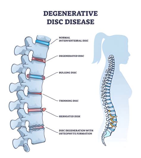 Degenerative Disc Disease In The Neck C5 6 And C6 7 Symptoms And