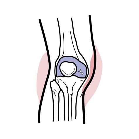 Osteomalacia Rickets Armando Hasudungan