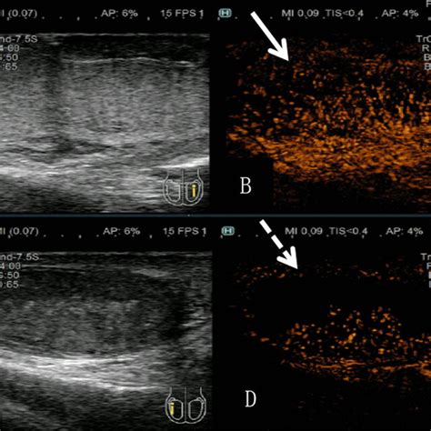 Normal Testis Using High Frequency Ultrasound A And Ceus B