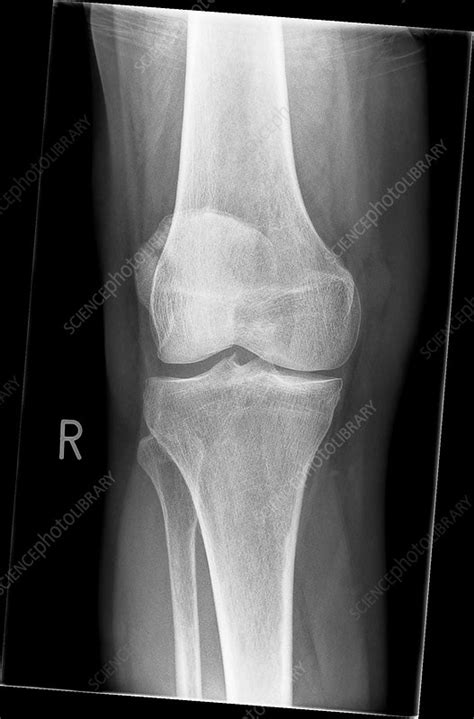 Normal Patella Radiograph Preoperative Skyline View Of The