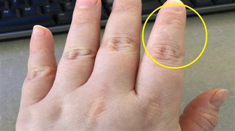 Fabulous Info About How To Get Rid Of Finger Fat Dugdrive82