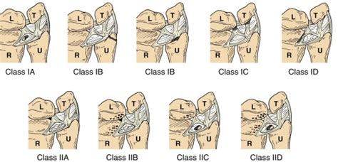 Classification Of Tfcc Lesions According To Atzei Erwiml