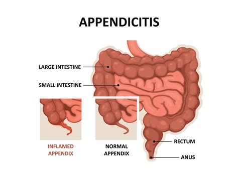 Appendicitis 88Guru