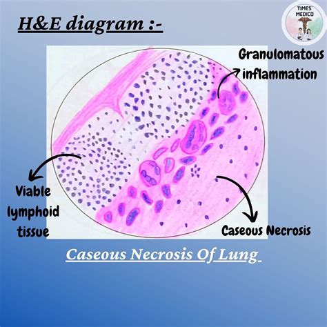Caseous Necrosis Histology