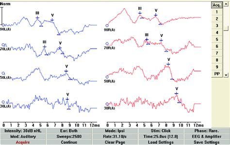 Auditory Brainstem Response Waveform For Threshold Estimation Waveform