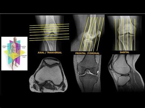 Resonancia Magnética De Rodilla Anatomía Parte 1 Youtube