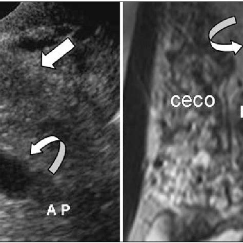 Image Of The Ileocecal Junction And Appendix Suggestive Of