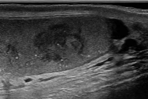 Urinary Tract And Male Reproductive System 23 Scrotum Case 239