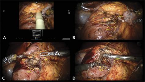 Isolated Resection Of The Uncinate Process Of The Pancreas By Robotic
