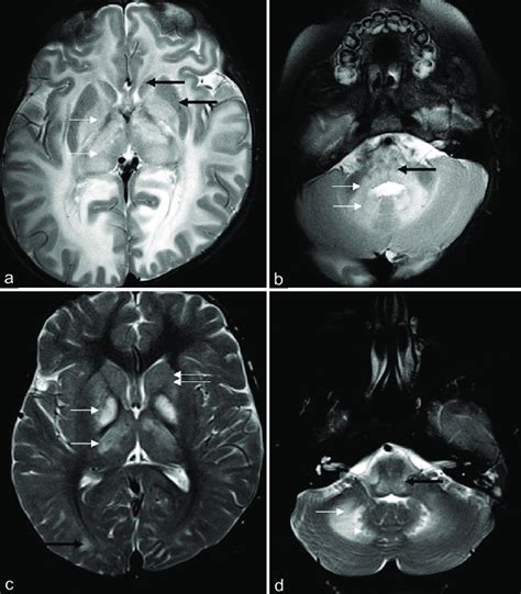 Differential Diagnosis Of L 2 Hydroxy Glutaric Aciduria Imaging