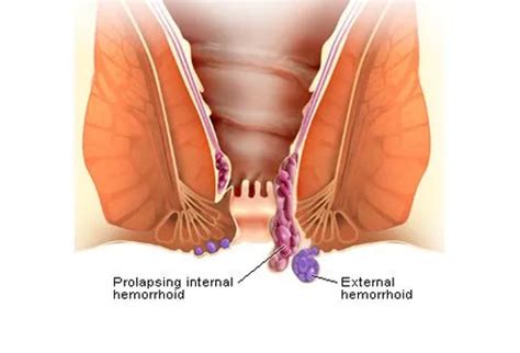 Hemorrhoids Internal External Symptoms Causes Treatment