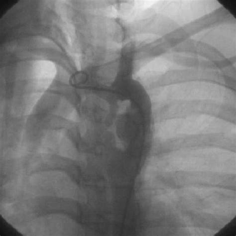 Hemashield Y Graft Was Implanted To Descending Aorta With End To Side Download Scientific