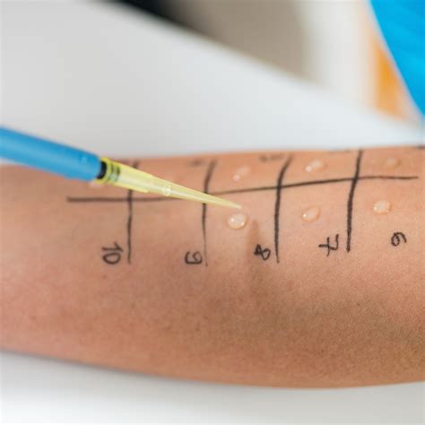 Prick Test Clínica Ideal