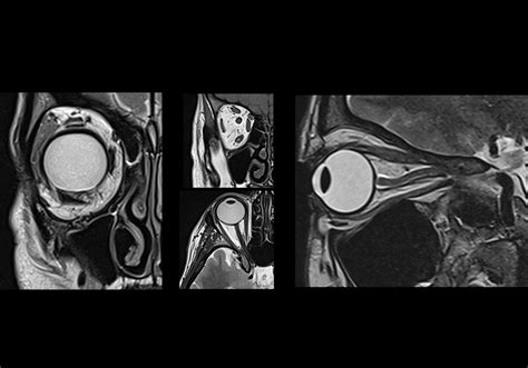 Anatomy Of The Orbits Annotated Mri E Anatomy