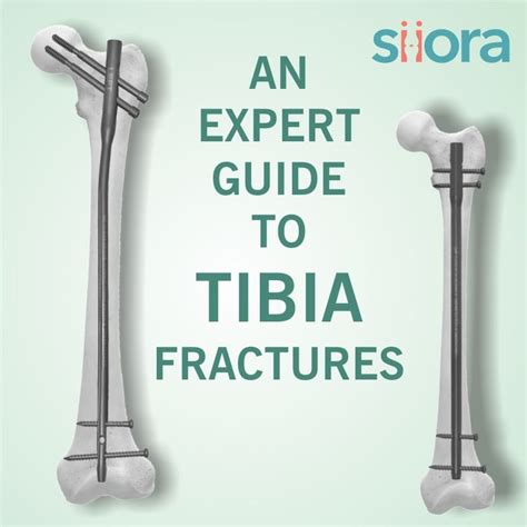 Tibia Fractures An Experts Guide Tibia Fractures An Experts Guide
