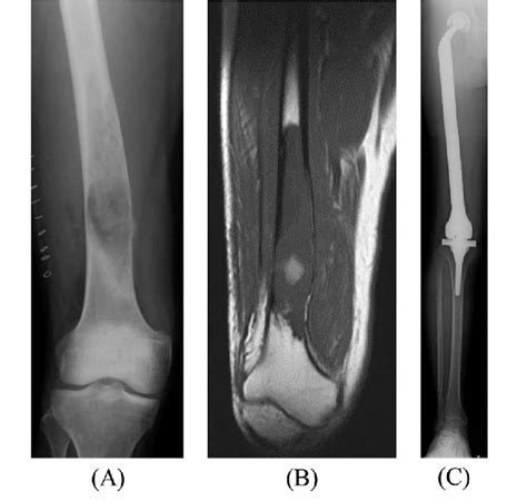 A X Ray Of The Right Distal Femur Of 33 Year Old Man With A Low Grade