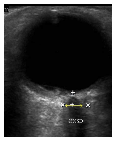 Optic Nerve Sheath A Normal Diameter And B Large Diameter That