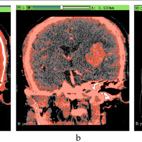 Schematic Diagram Of Hematoma Extraction A Mask Effect B Smoothing
