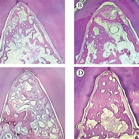 Mesiodistal Histologic Section Of Class Ii Furcation Lesion Stained