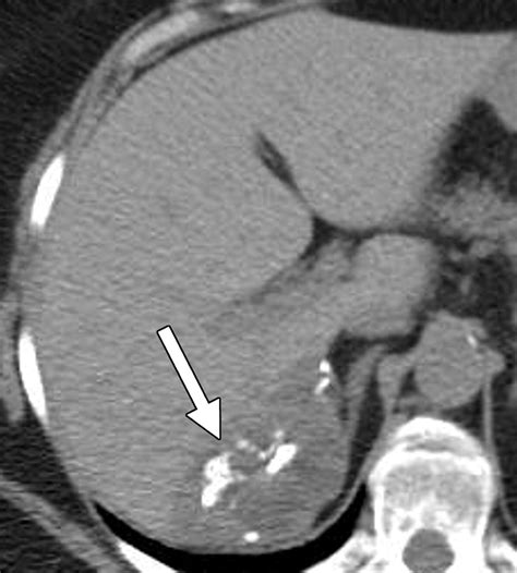 What Are Vascular Calcifications In The Pelvis At Timothy Horton Blog