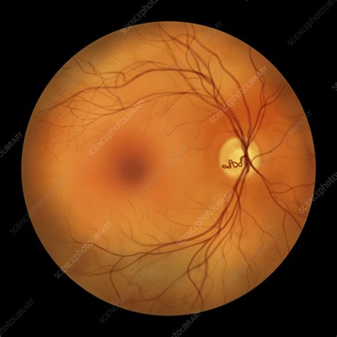 Prepapillary Vascular Loop On The Retina Illustration Stock Image