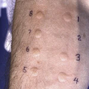 Skin Prick Allergy Test Panel Skin Prick Test Procedure Ypdjh