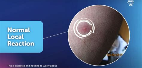 Tick Bites Nhs Inform